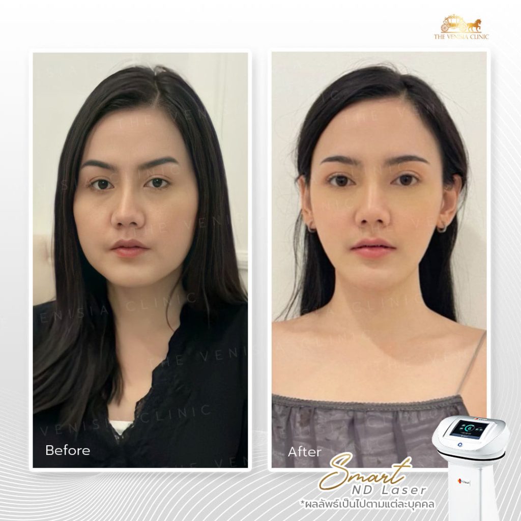 รีวิว Smart ND Laser (เลเซอร์เข็ม) – The Venisia Clinic